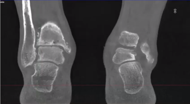 3D pedCAT Scanner Foot and Ankle Pain Treatment in Boca Raton Fl