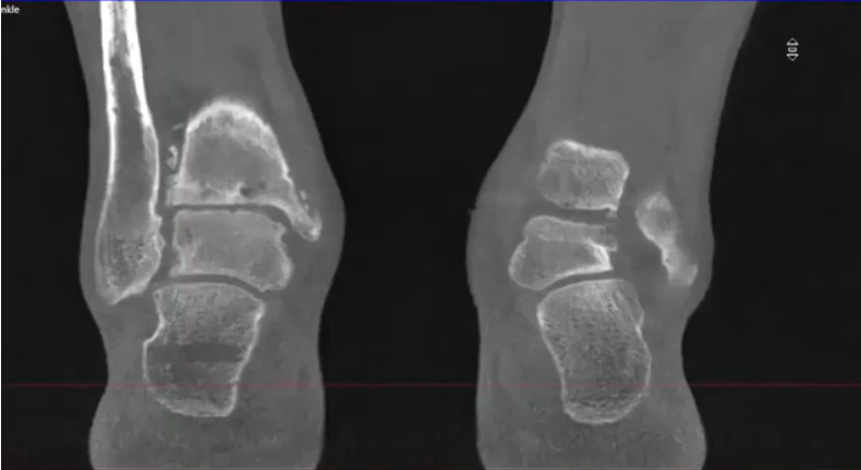 3D pedCAT Scanner Foot and Ankle Pain Treatment in Boca Raton Fl