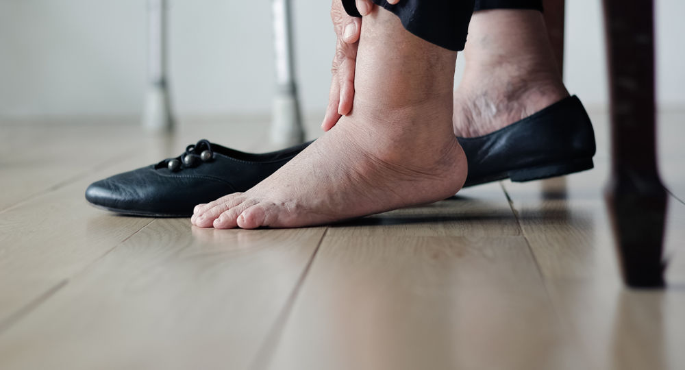 How To Treat Swollen Feet And Ankles And Legs 