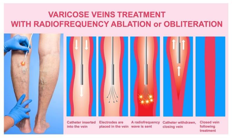 Radiofrequency Vein Ablation Treatment for Venous Insufficiency