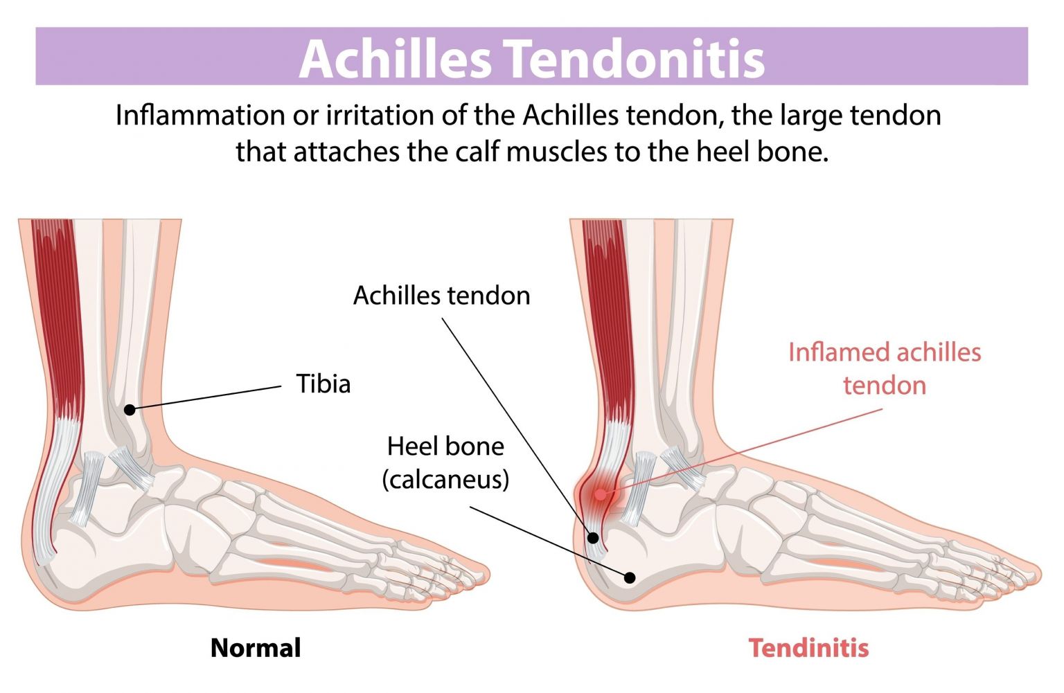 Achilles Tendonitis: Common Symptoms, Diagnosis and Treatment
