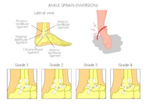 How and Why Does Inversion Ankle Sprain Affect Athletes