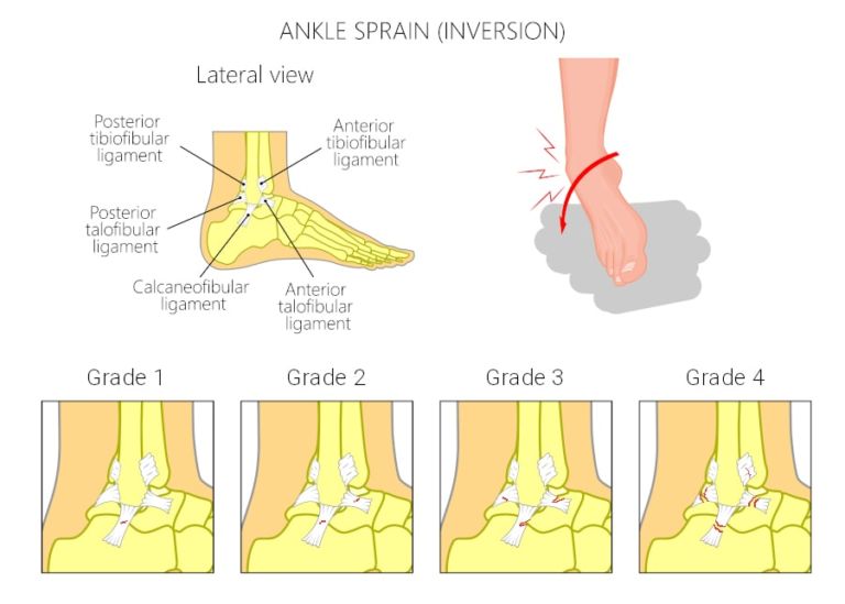 How and Why Does Inversion Ankle Sprain Affect Athletes
