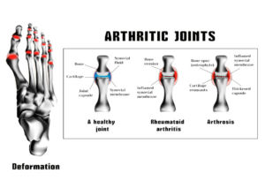 Foot Arthritis Pain and Arthritic Joints Can Be Difficult