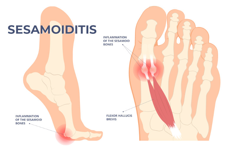 How To Deal With Issues With The Sesamoid Bone In The Foot How To Deal With Issues With The Sesamoid Bone In The Foot