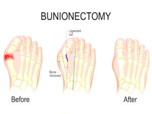 Minimally Invasive Bunion Surgery - Choose the new Technique!