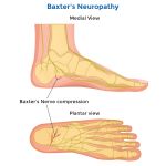 Baxter’s Nerve Entrapment unraveling the mystery behind it!