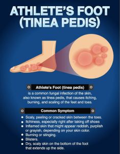 Effective Treatment for Athletes Foot and Nail Fungus