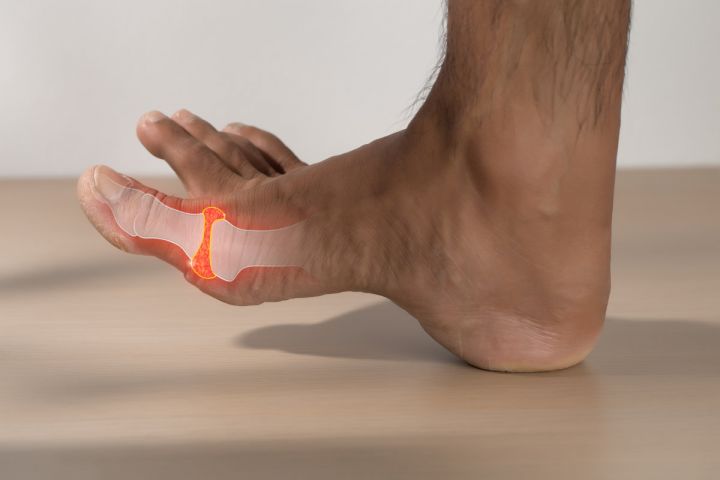 Arthritis in Big Toe Joint: Pain Relief Tips