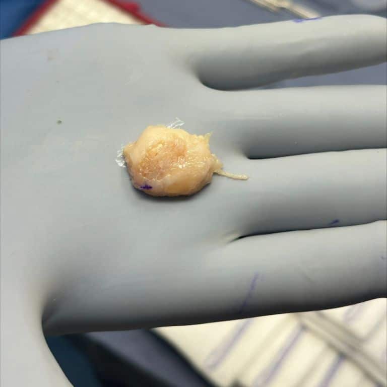 Arthritis in Big Toe Joint: Pain Relief Tips