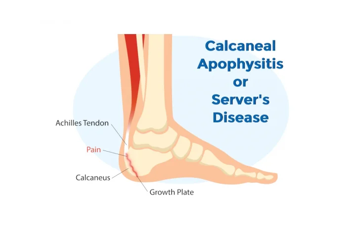 Understanding Calcaneal Apophysitis (Sever's Disease)