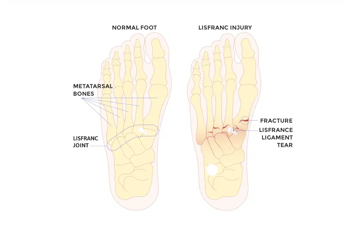 Lisfranc Injury: Understanding Recovery and More