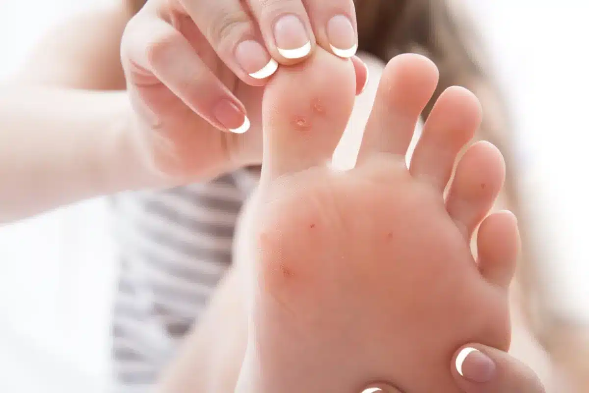 Plantar Wart on Toe: Causes, Symptoms & Treatments
