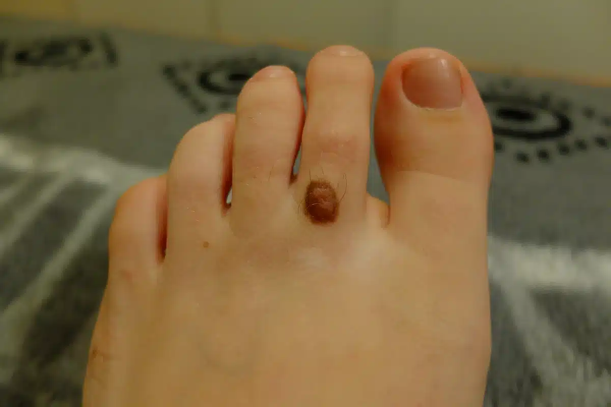 Melanoma on Foot: Signs, Risks, and Early Detection