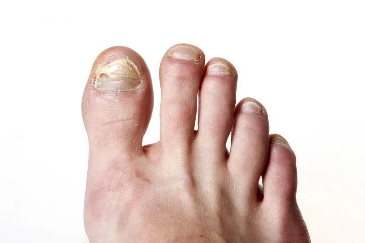 What Kills Toenail Fungus Instantly? Top Treatments Explained