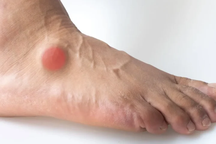 Bone Spur on Top of Foot: Expert Podiatrist Treatment Guide